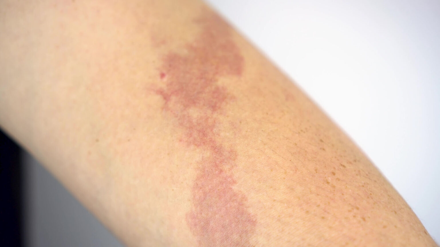 Treating Birthmark, Skin Conditions & Skin Concerns