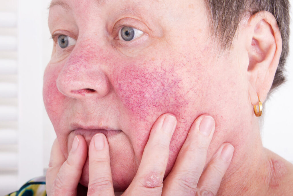Treating Facial Redness, Skin Conditions & Skin Concerns