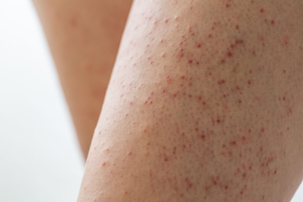 Treating Keratosis Pilaris, Skin Conditions & Skin Concerns